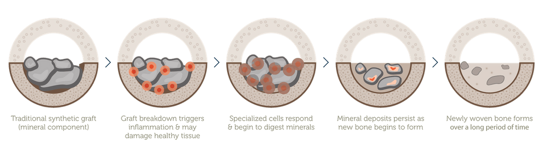 InQu® Bone Graft Extender & Substitute | Isto Biologics