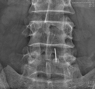 infiltrations épidurales