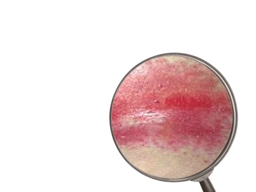 Intertriginous dermatitis - Treatment and nursing care