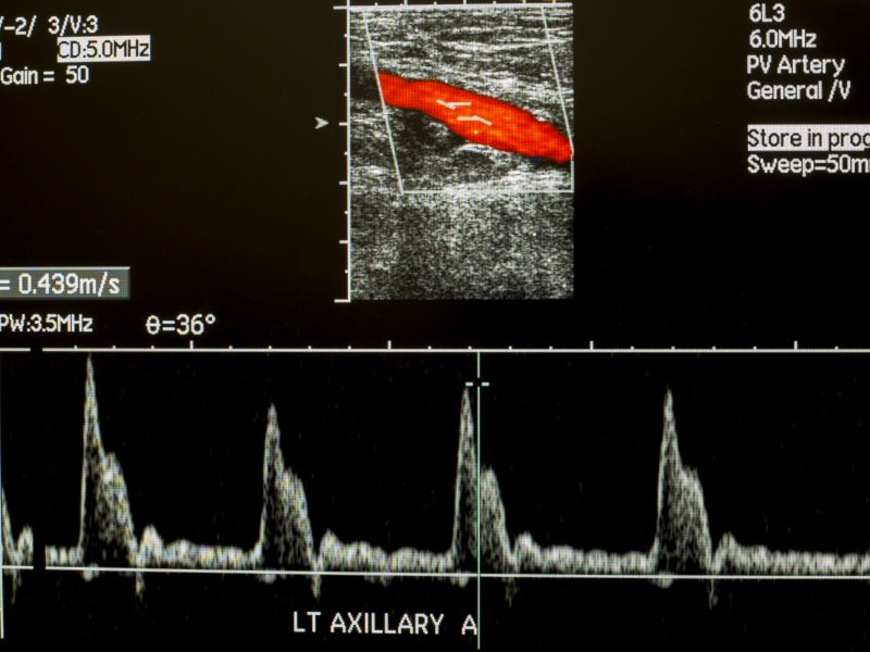 Doppler ultrasound for deep vein thrombosis