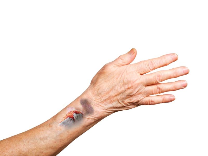 Skin tears in older adults: Nursing care