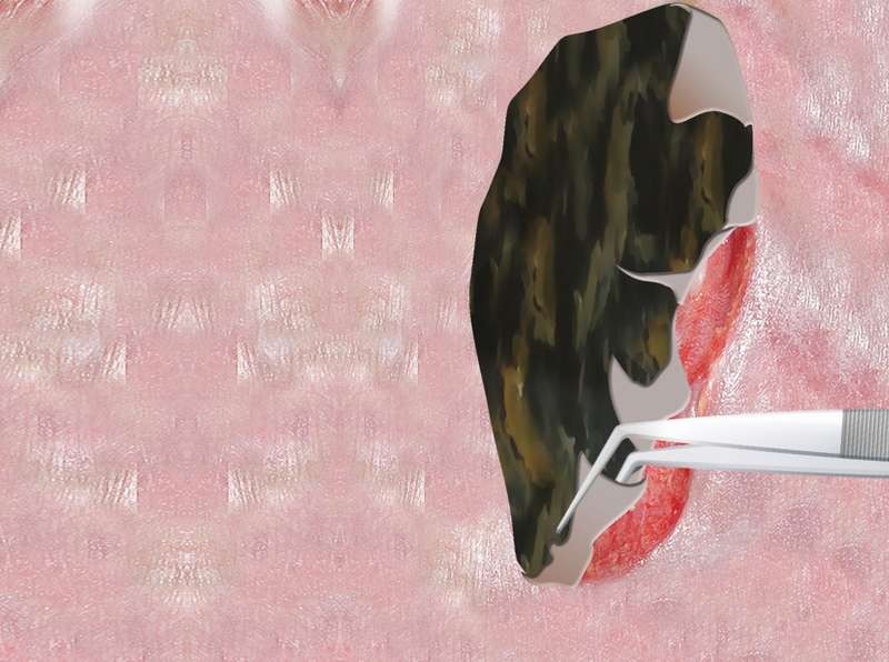 Pressure injuries part 2: Pressure injury classification and treatment