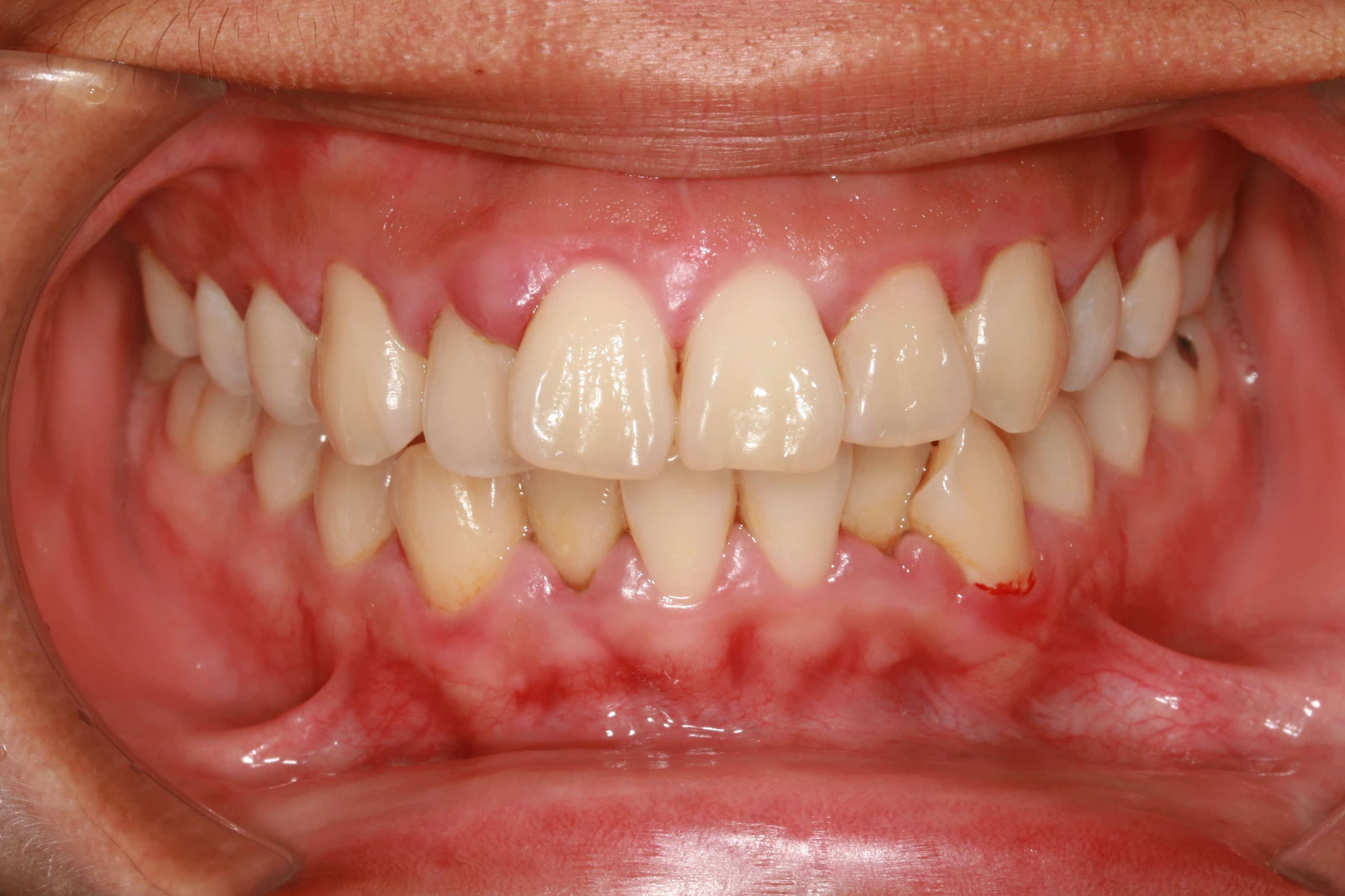 Gingivitis - Symptome, Ursachen und Behandlung