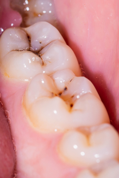 Karies: Symptome, Stadien & Behandlung - Zahnarzt Dr. Kraus