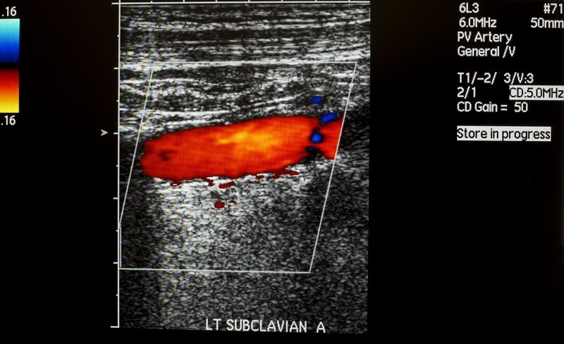 Doppler ultrasound for deep vein thrombosis | HealthStaffEd