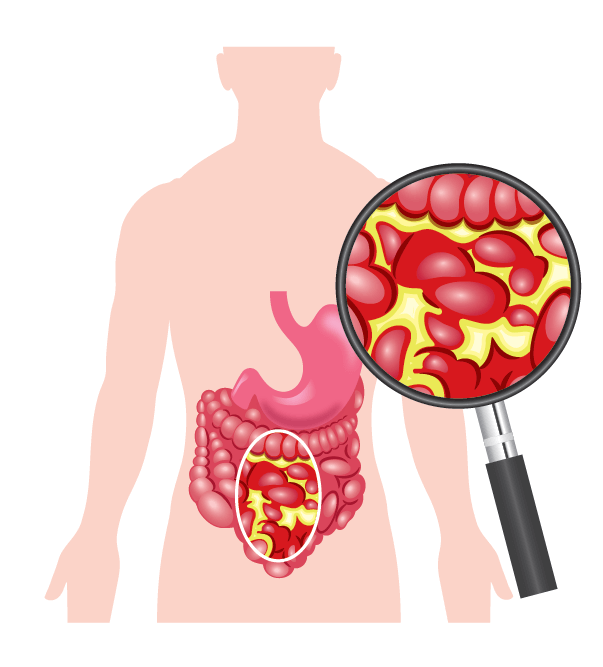 Peritonitis – A complication of peritoneal dialysis | HealthStaffEd