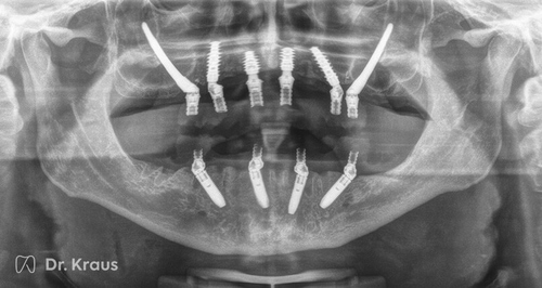 All on 4 Vorher-Nacher-Bilder » 47 Fotos von Zahnimplantaten