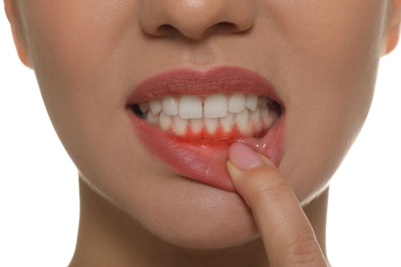 Zahnfleischbehandlung & Kürettage » Parodontologie in Mainz