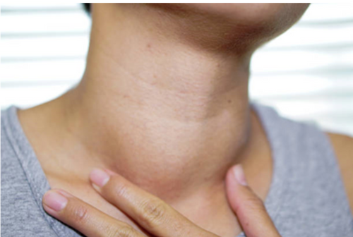 How To Shrink A Goiter | Paloma Health