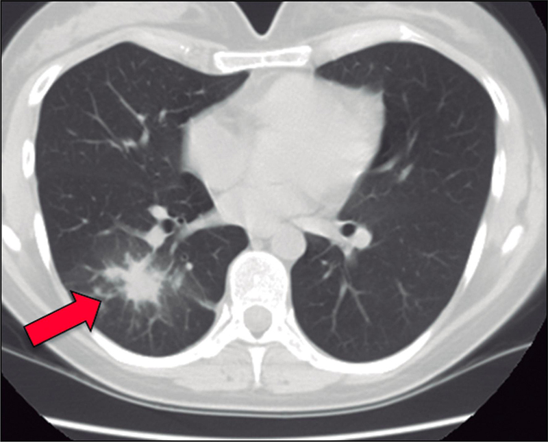 Diagnóstico de Aspergilosis Invasiva (AI): El resultado confiable ...