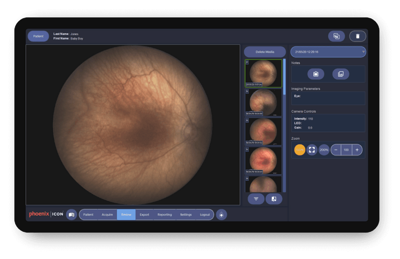 ICON CartTransform Your Neonatal ROP Practice using ICON™ with Patented ...