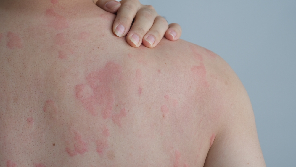 Hives Rash Pictures Hives Rash Pictures
