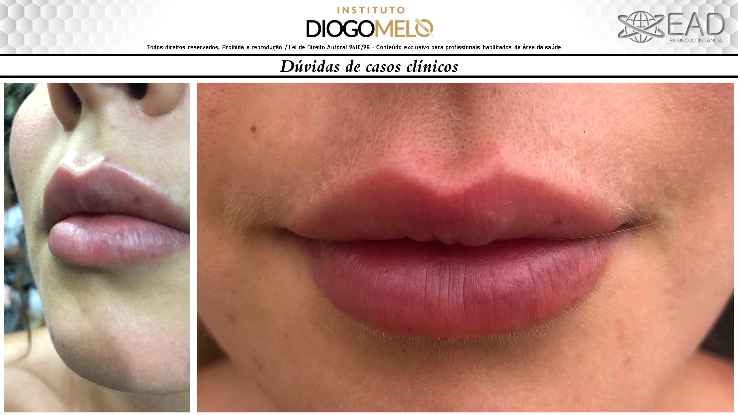 Rennova Fill Ou Lift Para Lábios - RETOEDU