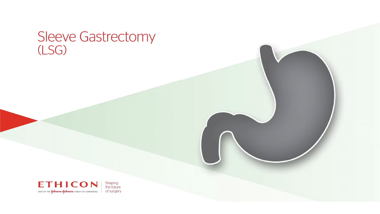 Bariatric surgery | Sleeve gastrectomy | Gastric bypass
