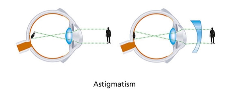 Astigmatism (Irregularly shaped eyeball) | Dr Tint | Edinburgh, Scotland