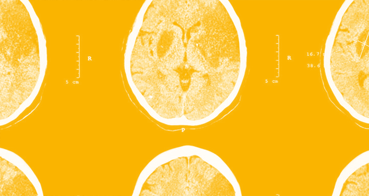 Reconnaître un AVC : les 4 signes qui doivent vous alerter ⚡️