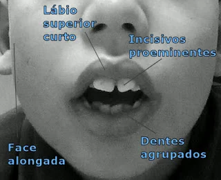 Hipertrofia das adenoides: da clínica ao tratamento