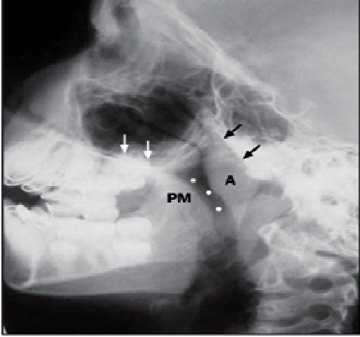 Hipertrofia das adenoides: da clínica ao tratamento