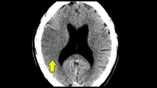 Como identificar os sinais de derrame cerebral