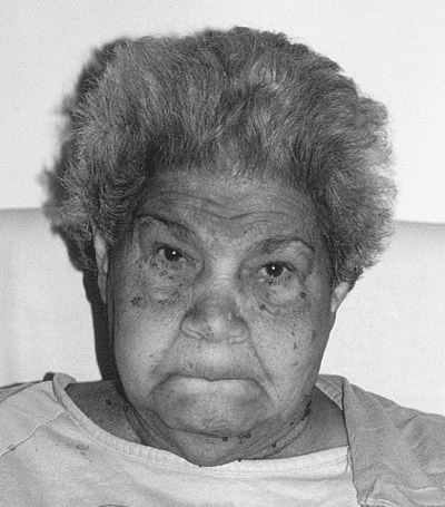 Saiba qual a fisiologia do hipertireoidismo e do hipotireoidismo