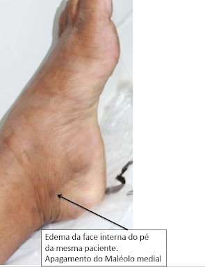 Qual o tratamento para o paciente com hipertensão arterial?