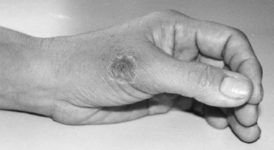 Doença de Chagas: fases, diagnóstico e tratamento