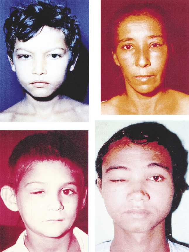 Doença de Chagas: fases, diagnóstico e tratamento