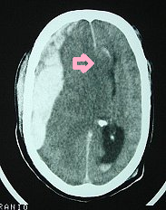 Hipertensão Intracraniana (HIC): você domina o manejo?