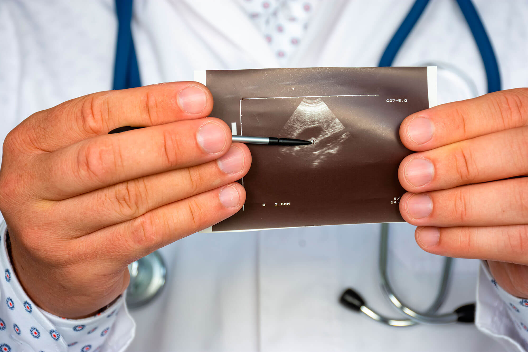 Câncer de Vesícula Biliar: Sinais, Sintomas e Tratamento