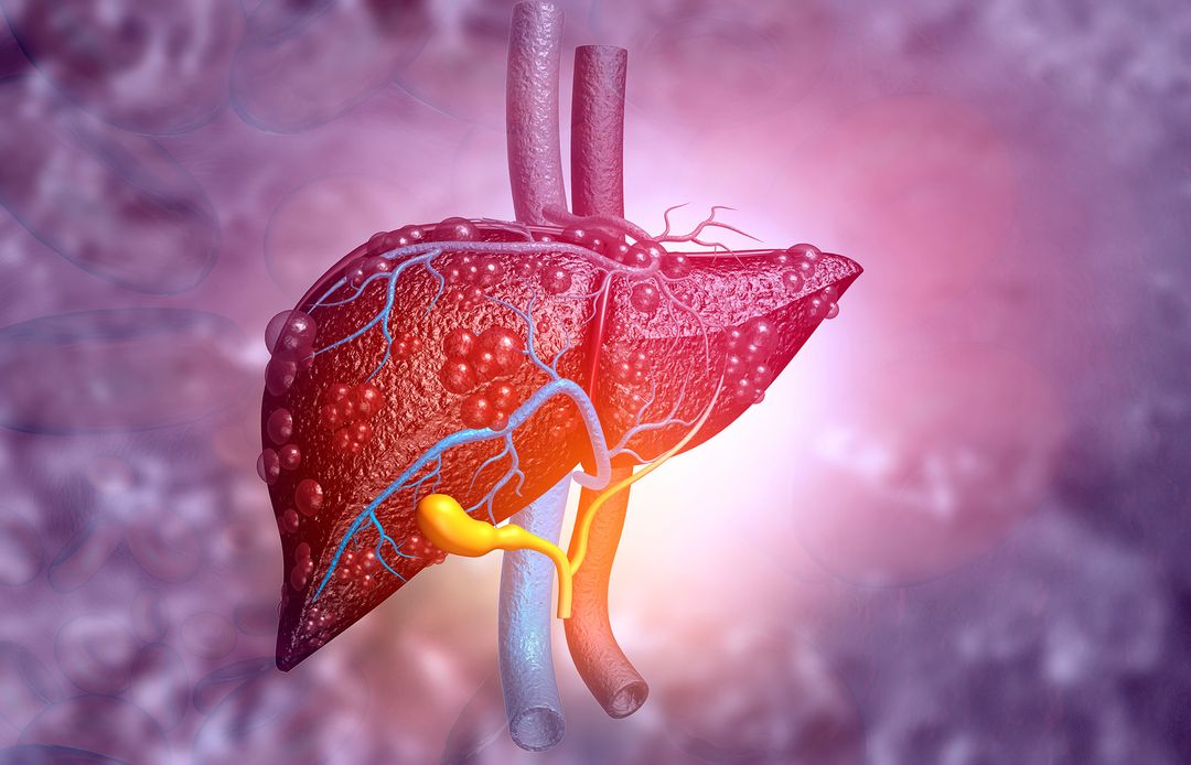 Doença hepática crônica: o que é, estágios e tratamento