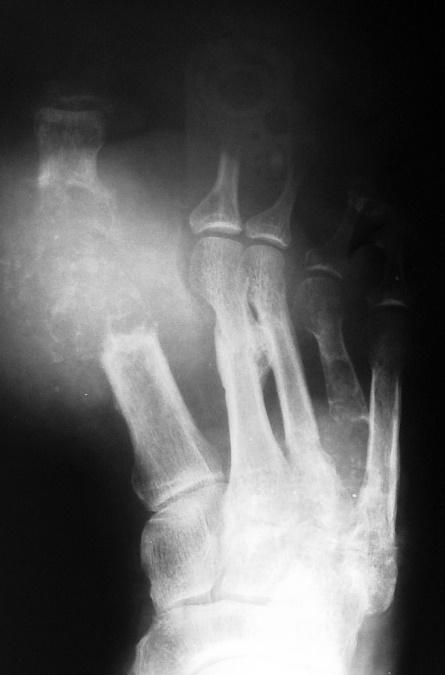 Gota: origem, tipos e tratamentos