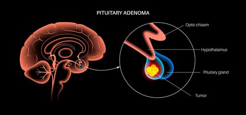 Acromegalia: O que é, sintomas, tratamentos e causas.