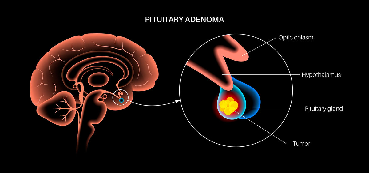 Acromegalia: O que é, sintomas, tratamentos e causas.