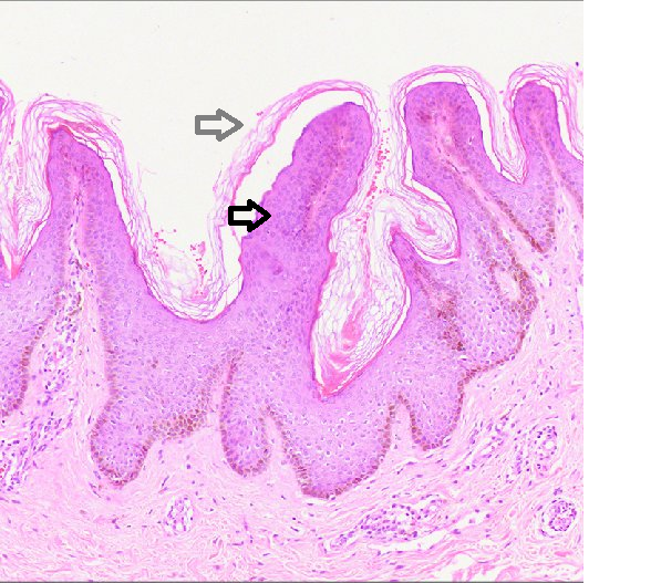 Acantose nigricans: origem, causas e tratamento