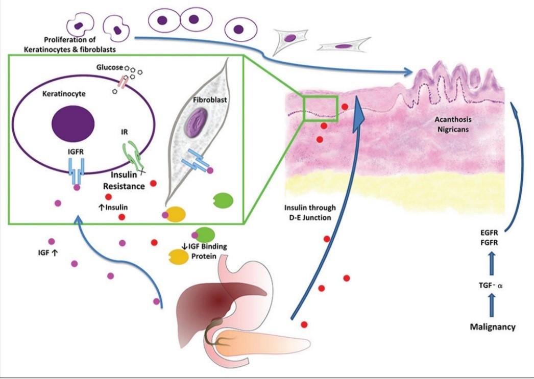 Acantose nigricans: origem, causas e tratamento