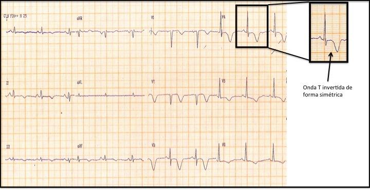 Síndrome Coronariana Aguda: o que é, causas e diagnóstico