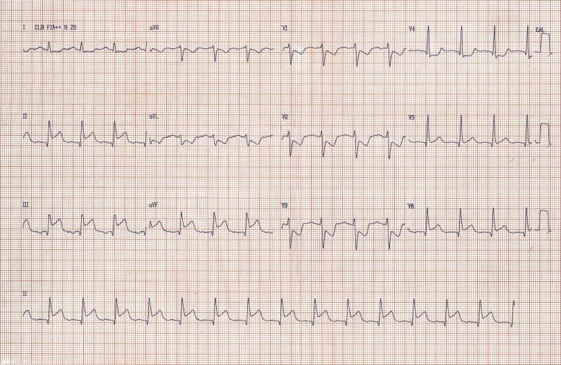 Síndrome Coronariana Aguda: o que é, causas e diagnóstico