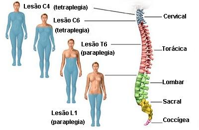 Trauma raquimedular: Etiologias, Tipos e Diagnóstico