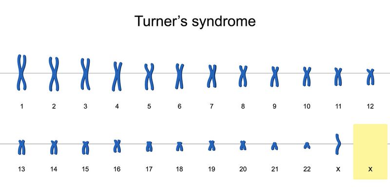 Sindrome Turner: Definição, características e tratamento