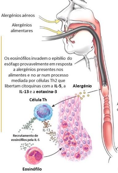 Esofagite Eosinofílica: Fisiopatologia, Causas e Tratamento