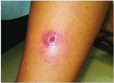 Leishmaniose tegumentar: Definição, causas e tratamento