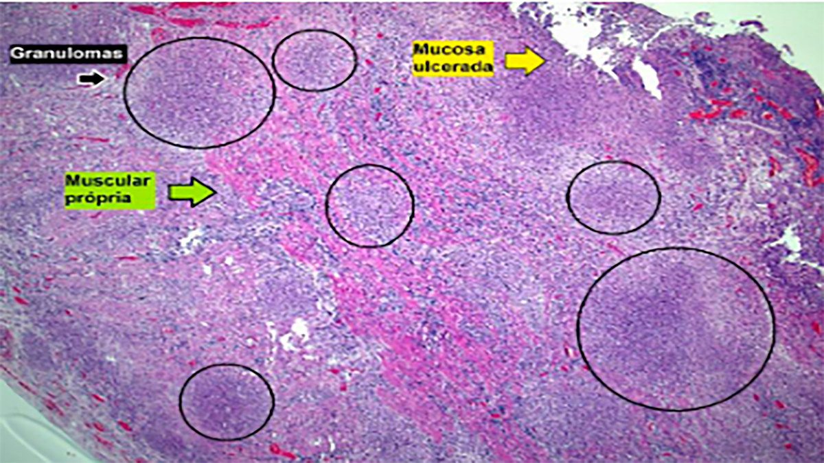 Tuberculose intestinal: o que é, as causas e tratamento