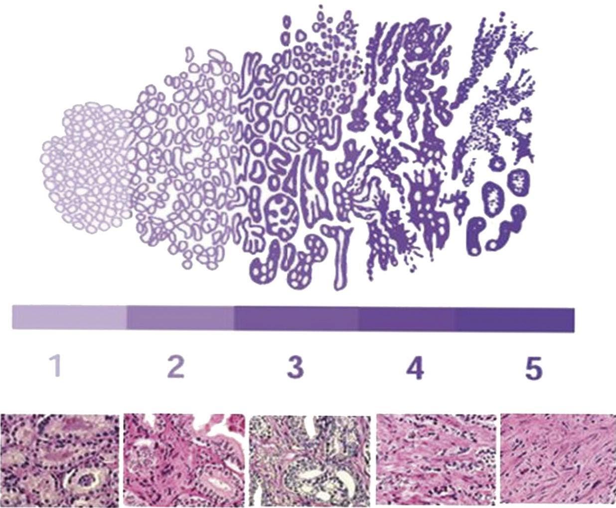 Câncer de Próstata: O que é, Diagnóstico e Tratamento