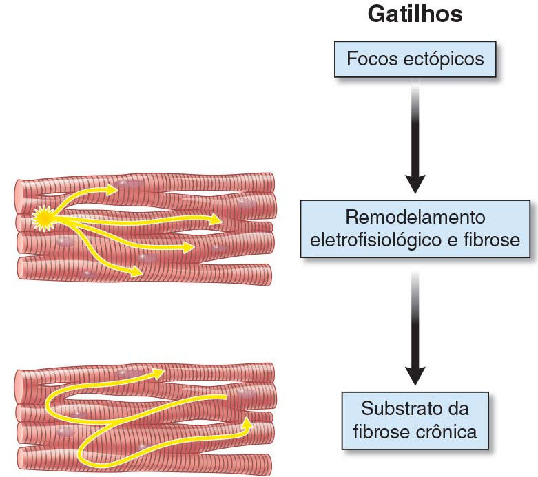 Fibrilação atrial: o que é, as causas e tratamento