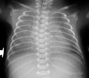 Distúrbios respiratórios do recém-nascido: o que é, diagnóstico e ...