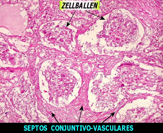Feocromocitoma: O que é, Diagnóstico e Tratamento
