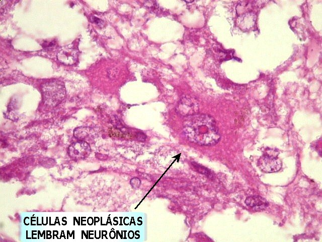Feocromocitoma: O que é, Diagnóstico e Tratamento