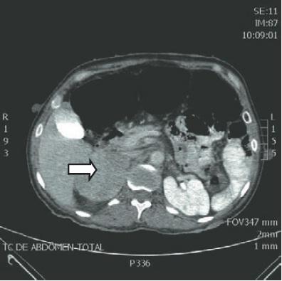 Feocromocitoma: O que é, Diagnóstico e Tratamento