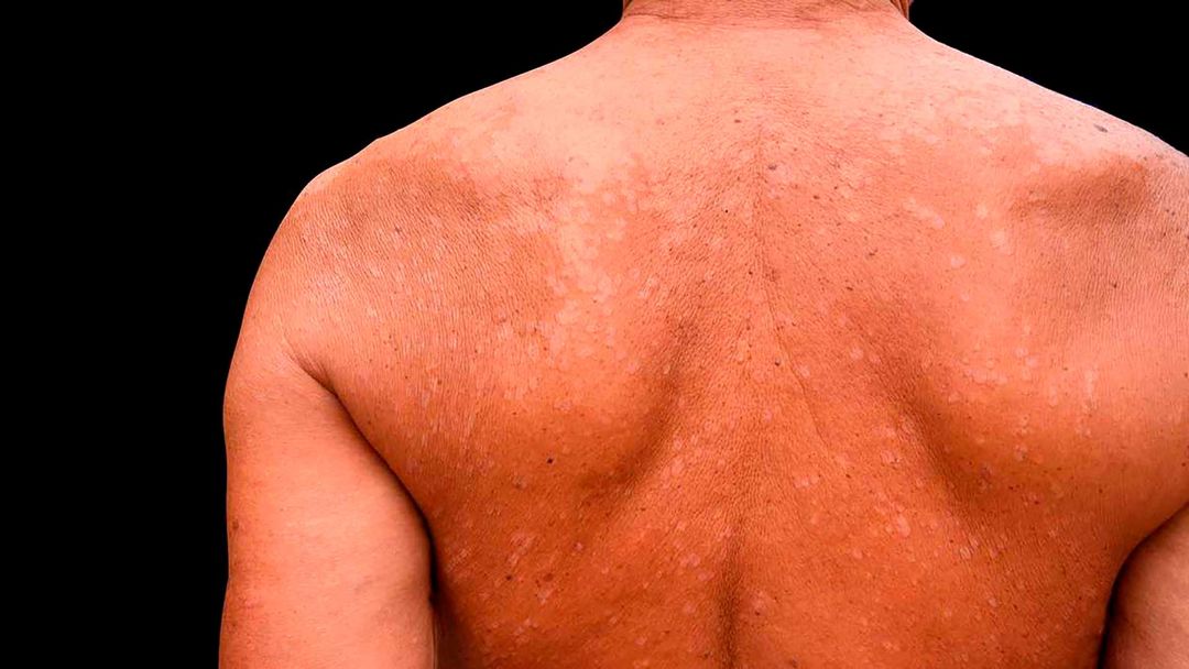 Pitiríase Versicolor: O que é, Sintomas e Tratamento