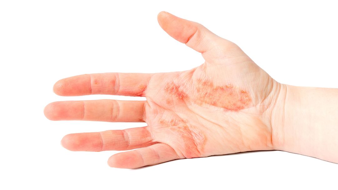 Disidrose: o que é, diagnóstico e tratamento
